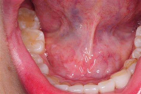 What Causes Swollen Glands In Mouth At Pearl Jenks Blog