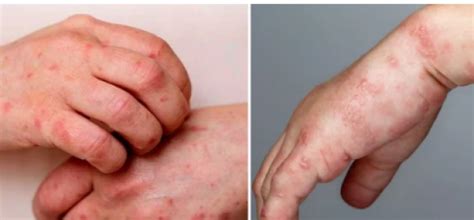 Las Diferencias Entre La Viruela Símica Y Herpes Zóster Delsur Diario