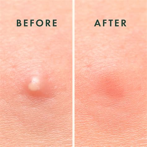 How To Use Acne Patch Clear Skin Quickly Best Blackheadremoval