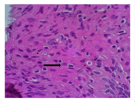 Demonstrates Von Hansemann Cells Filled Thick Arrow And Download