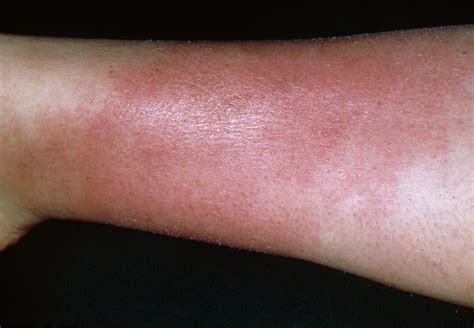 Cellulitis Symptoms Causes Pictures And Treatment