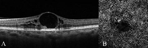 A Even After Four Intravitreal Injections The Intraretinal Cyst In Download Scientific