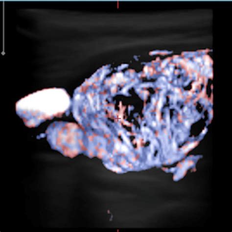 The Observed 3d Perinodular Vascularization Pattern A No Perinodular