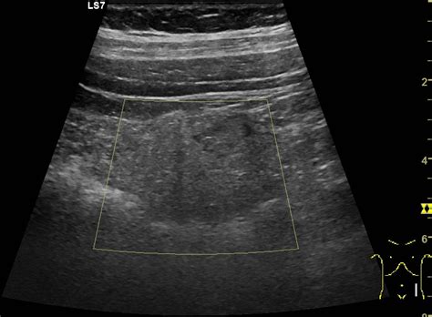 Radiopaedia Case Epiploic Appendagitis Id 81550 Study 95389 Nc Commons