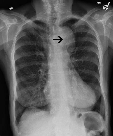 Aortic Dissection X Ray
