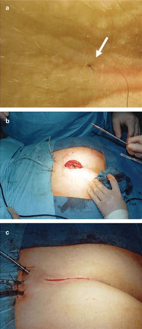 Excision Of A Chronic Pilonidal Sinus And Primary Symmetric Midline Download Scientific Diagram
