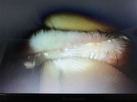 睑板腺功能障碍1例 医联