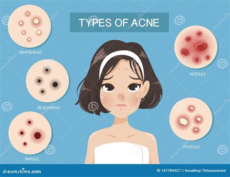 Types Of Acne By Woman Stock Vector Illustration Of Beautiful