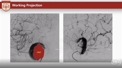 顾宇翔教授：血流导向装置治疗血栓性动脉瘤 脑医汇