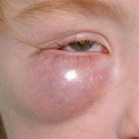 ऑर्बिटल सेल्युलाइटिस क्या है कारण लक्षण और इलाज Orbital Cellulitis