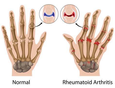 Ra Factor Test Diagnosing Rheumatoid Arthritis