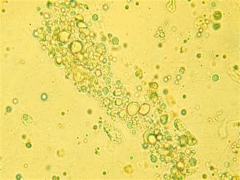 Atlas De Sedimento Urinario Sedimentarias Urinarios Eritrocitos
