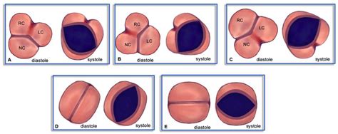 Bicuspid Aorta Valve