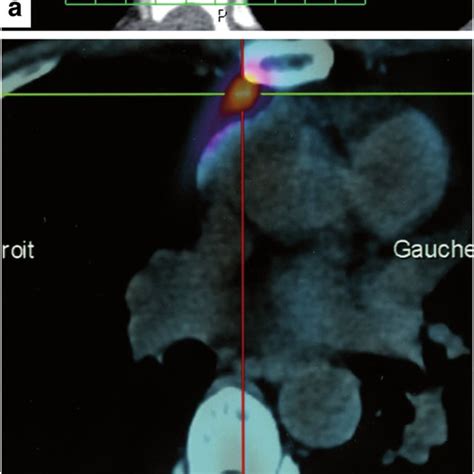 Pdf Thoracoscopic Partial Thymectomy For Untraceable Mediastinal