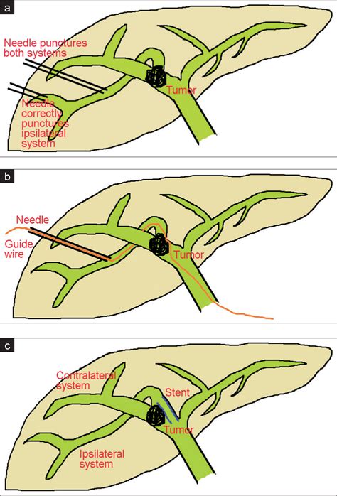Causes And Treatment Of Bile Leaks At The Puncture Site After