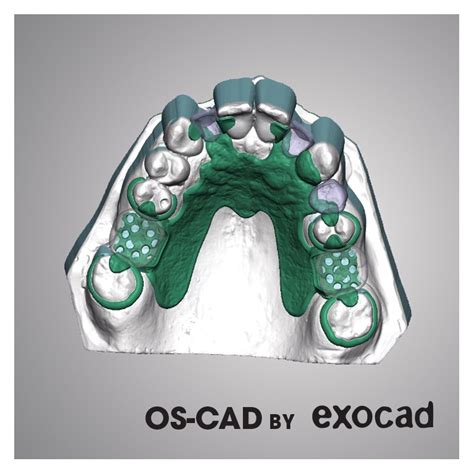 Exocad Crack Partial Framework Softdental