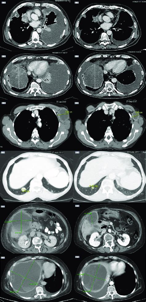 Representative Images Demonstrating Response A Baseline Computed