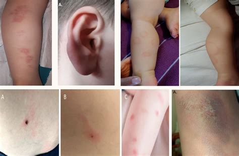 Medical Detective 3 Lets Talk About Lyme Rashes