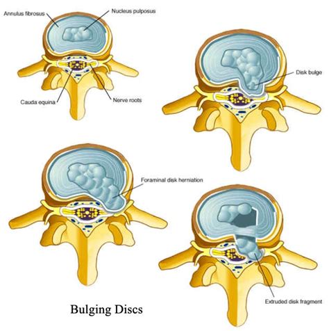Myo Therapy And Healthcare Institute When You Have A Bulging Disc How To