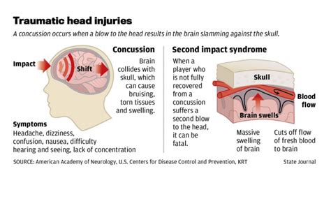 Concussion Access Ipc