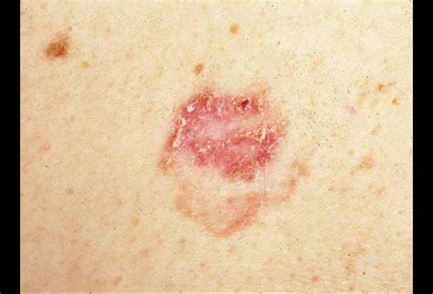 Malignant Skin Lesions