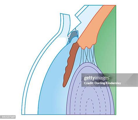 Trabeculectomy Photos And Premium High Res Pictures Getty Images