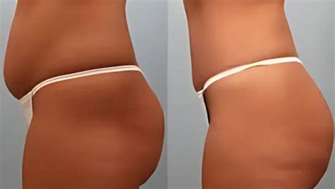 What Is Skinny Bbl Surgery Skinny Bbl Near Me