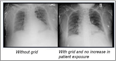 Dr Imaging To Use Or Not To Use A Grid Perlove