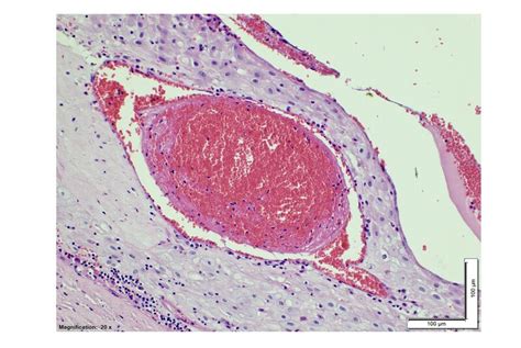 Nat Pernick On Linkedin Pregnant Women Should Not Be Left Alone The Missing Cause Of Death For