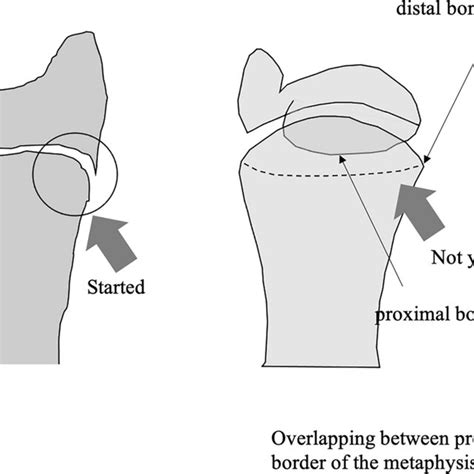 Illustrations To Show “capping Of Distal Radial Physis” And