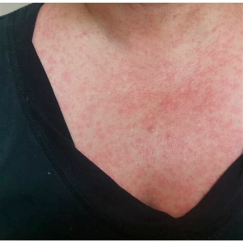 Maculo Papular Rash Download Scientific Diagram