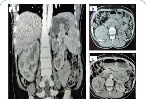 A B C 1 Year Follow Up Ct Scan Of 30 Year Old Diabetic After Medical Download Scientific
