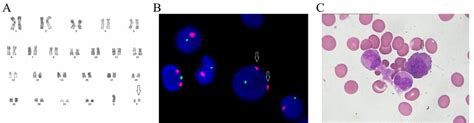 Karyotype Fish And Bone Marrow Analysis During The Appearance Of The