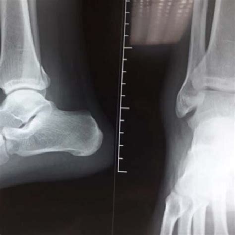 X Ray Images Showing An Isolated Fracture Of The Posterior Margin Of Download Scientific