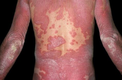 Psoriasis Especially Severe Disease Associated With Increased Risk