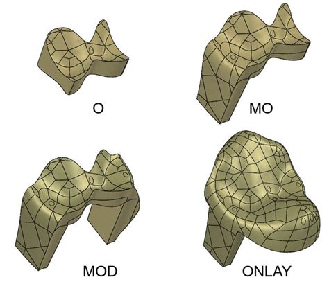 Models Of 3 Inlays And 1 Onlay Bodies Restored On The Maxillary Second