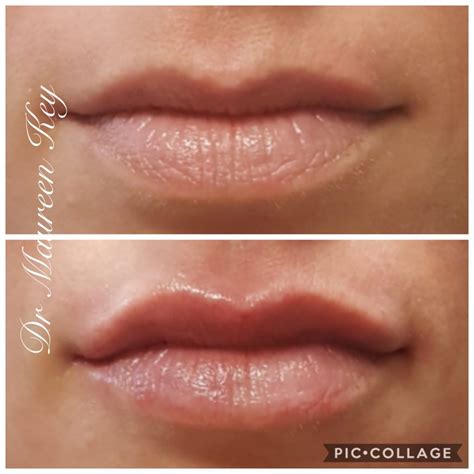 Lip Flip On Full Lips With Filler In Pueblo Lip Lift Botox