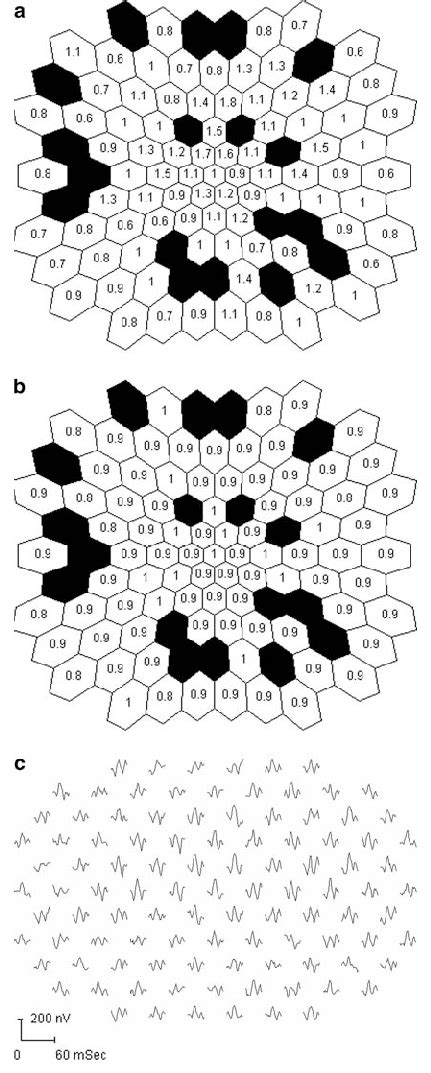 Multifocal Electroretinogram Mferg Results Of Xlrs Carrier 3 Download Scientific Diagram