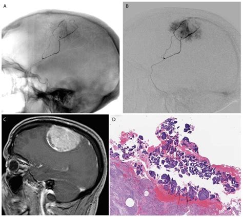 Endovascular Embolization By Transcatheter Delivery Of Particles Past Endovascular Embolization By Transcatheter Delivery Of Particles Past