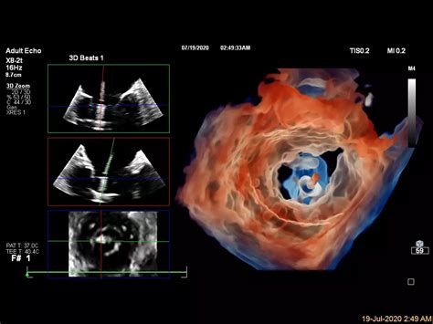 Epiq Cvx Cardiac Ultrasound