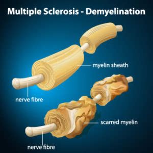 A Guide To Multiple Sclerosis For First Aiders First Aid For Free