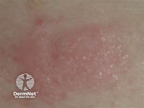 Baseline Series Of Patch Test Allergens