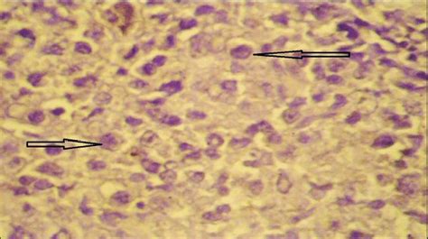 C Immunohistochemical Staining In Aml M1 Patient Technical Negative