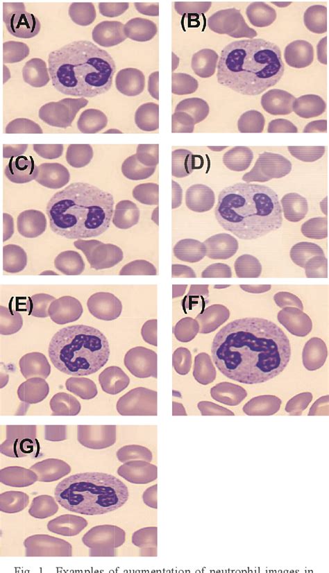 Figure 1 From Deep Learning Based Nuclear Lobe Count Method For Differential Count Of