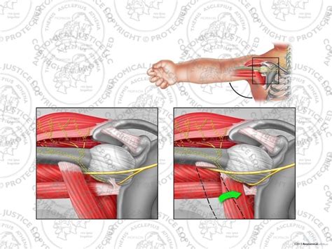 Left Ulnar Nerve Release And Transposition