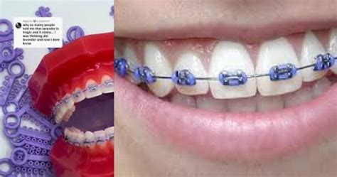 Lavender Braces The Trendy Way To Add Style To Your Smile