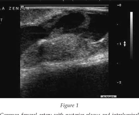Figure 1 From Role Of Intraoperative Completion Duplex Scan For