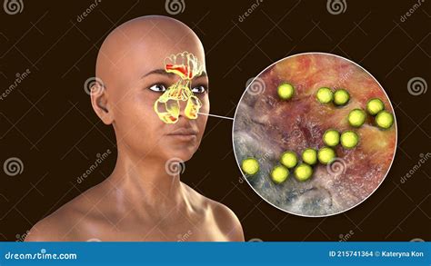 Streptococcus Pyogenes Bacteria And Other Streptococci As A Cause Of Sinusitis Stock