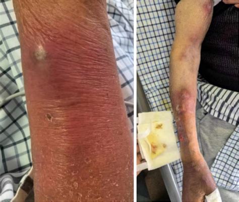 Chronic Renal Insufficiency Complicated By Skin Infection With Nocardia