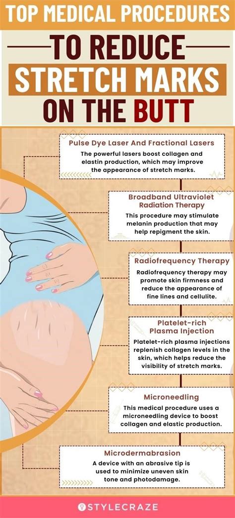 What Do I Have Stretch Marks At Henry Gale Blog